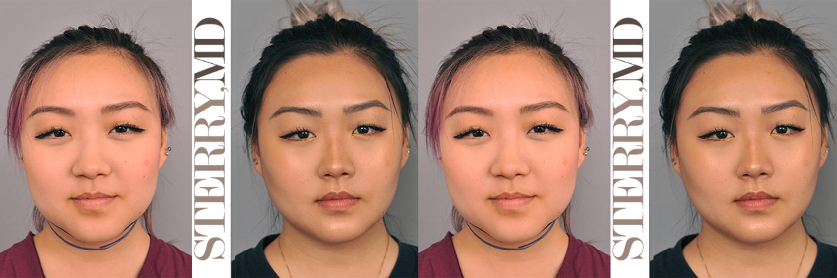 Buccal Fat Removal For Chubby Cheek Reduction Case #227
