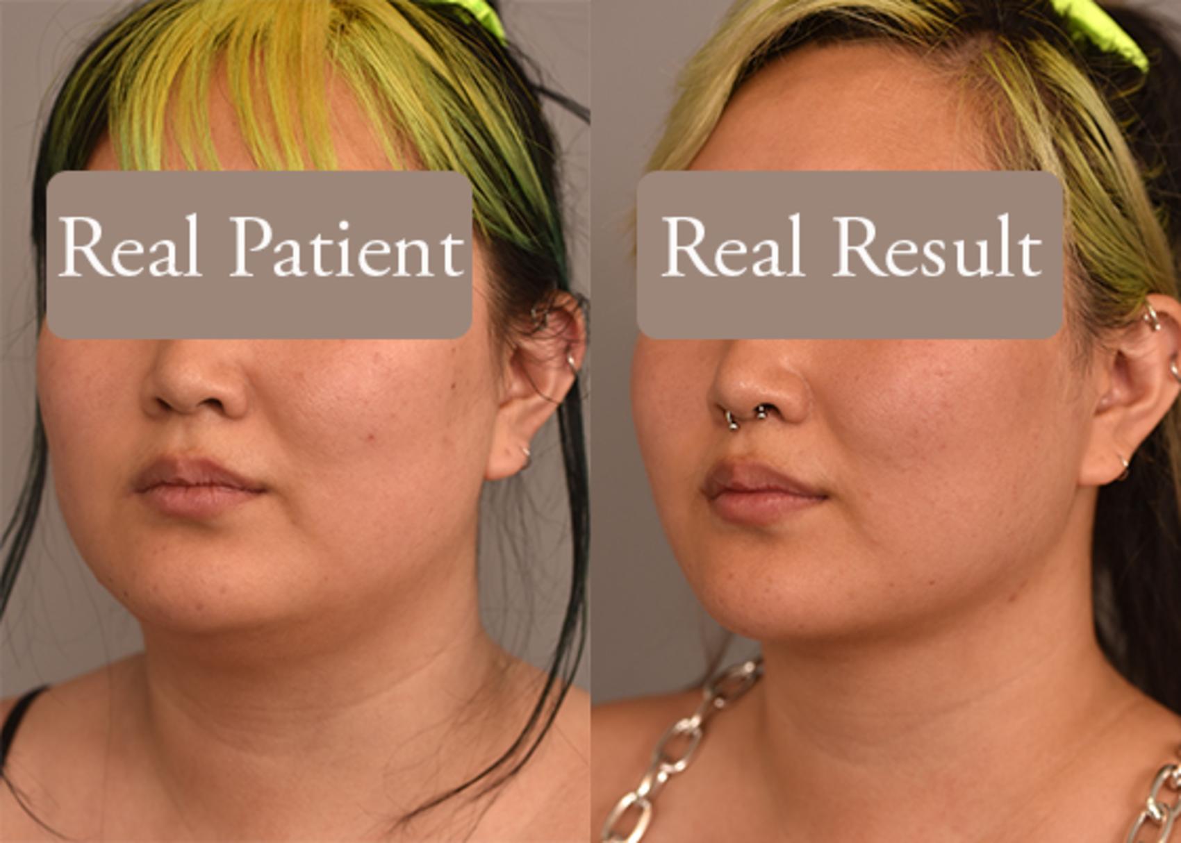 Cheek Liposuction Case #241