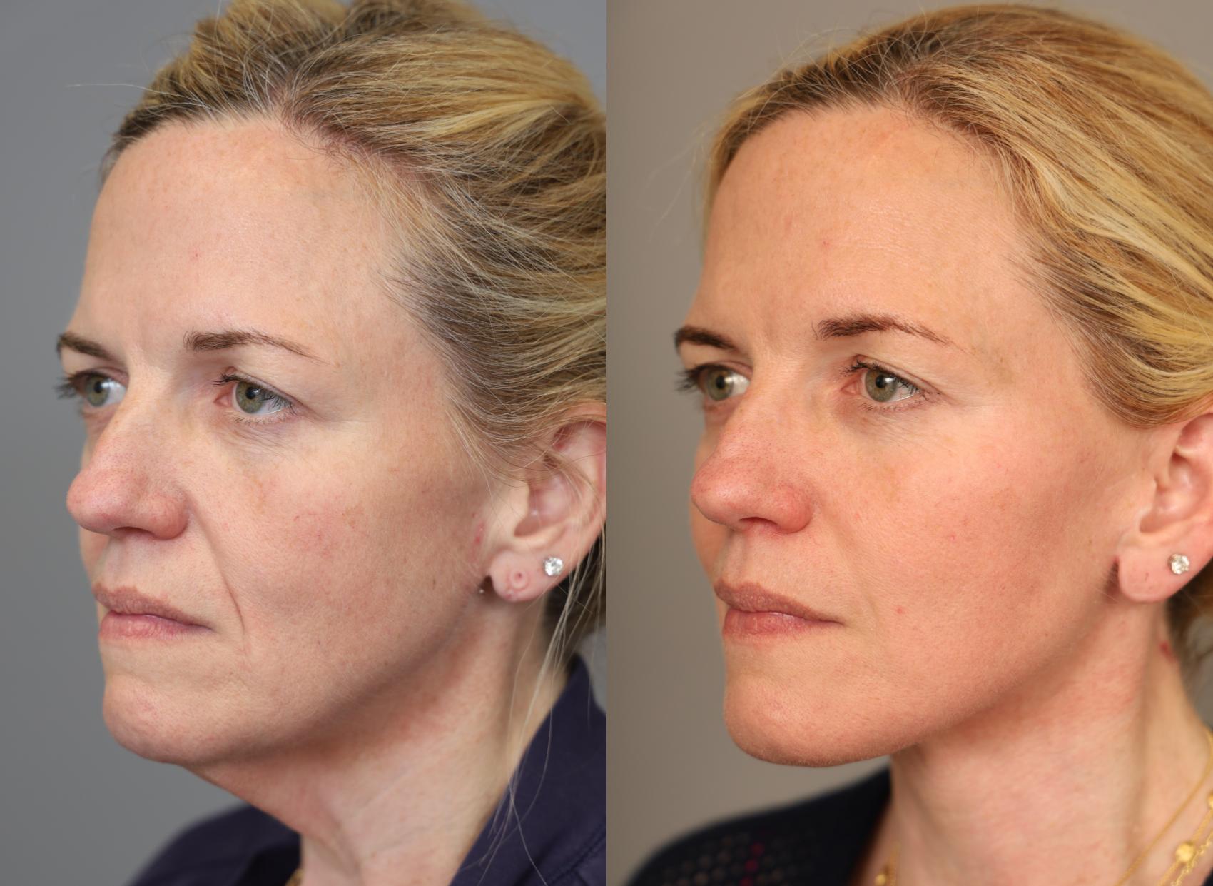 Facelift Before and After Pictures Case 307 | New York, NY | Thomas P ...