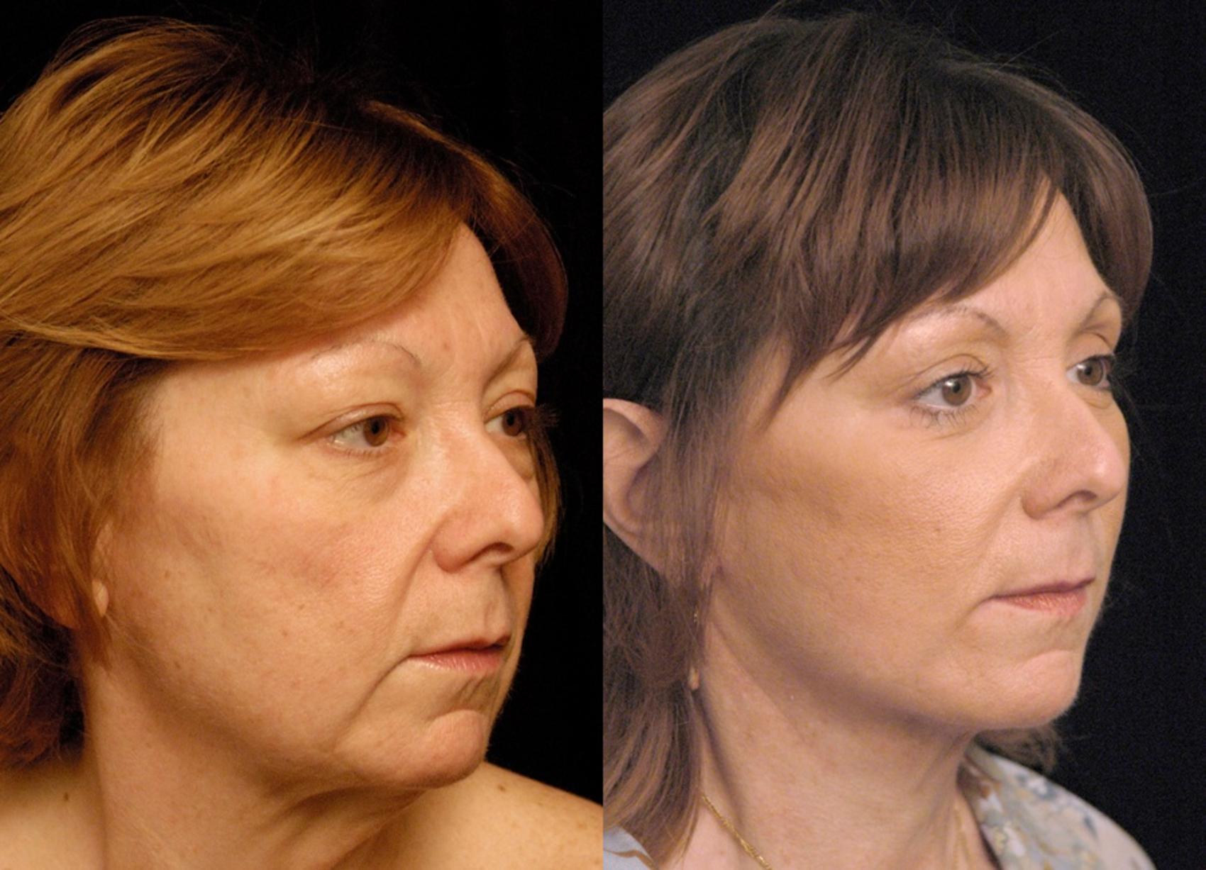 Facelift in New York City - Dr. Thomas Sterry