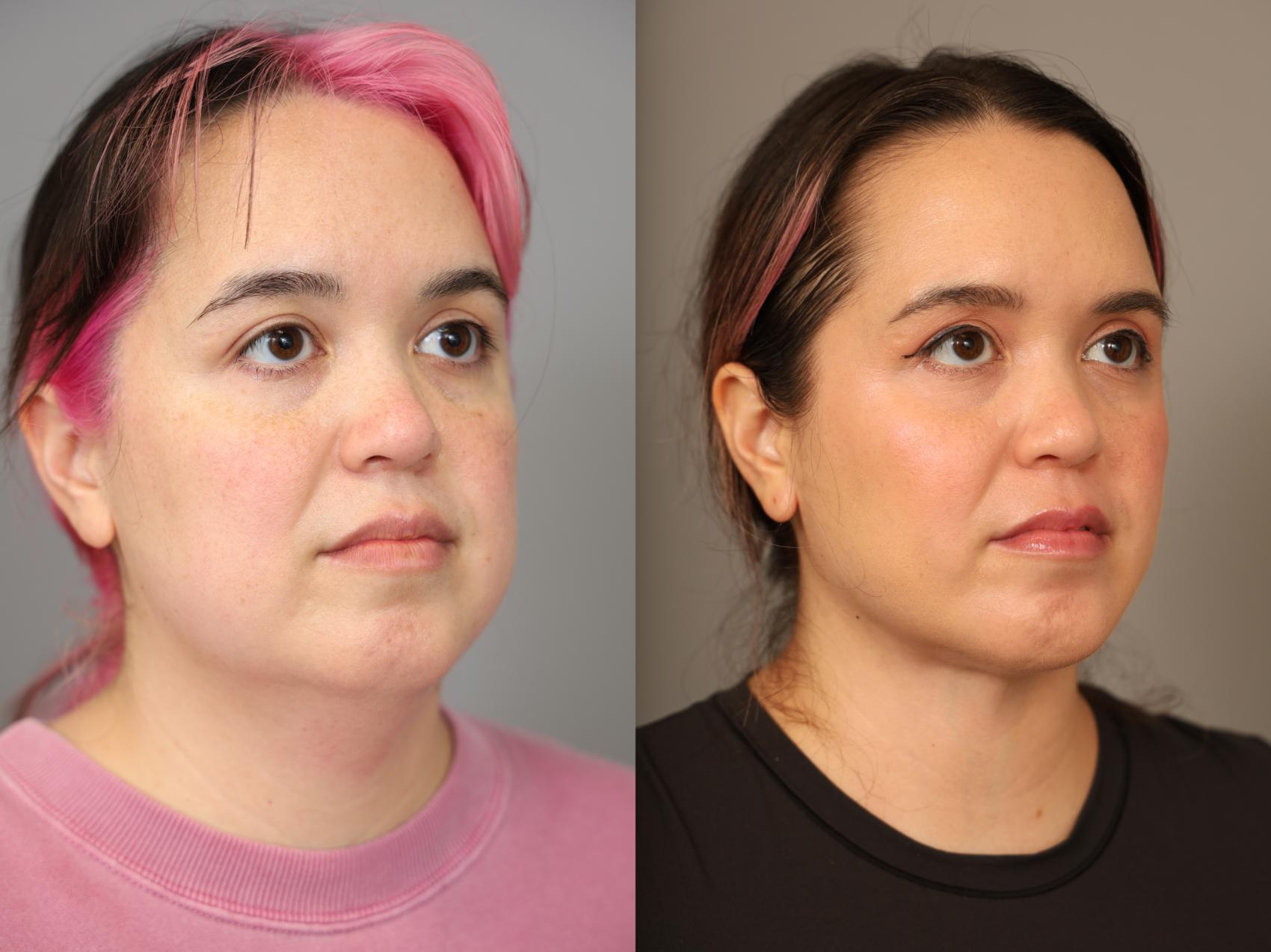 Mini Neck Lift (Single Incision) Before and After Pictures Case 316 ...