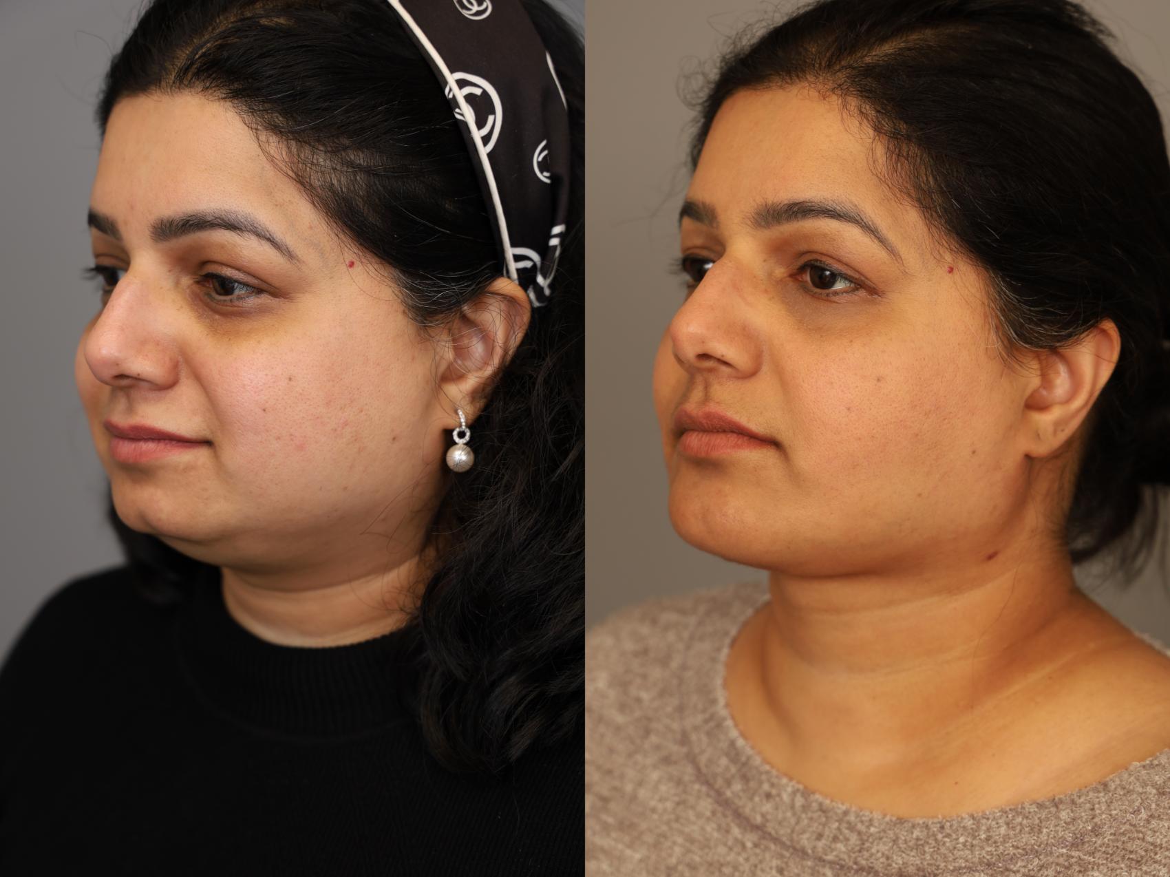 Neck Lift, Cheek Liposuction, and Chin Implant: Before & After