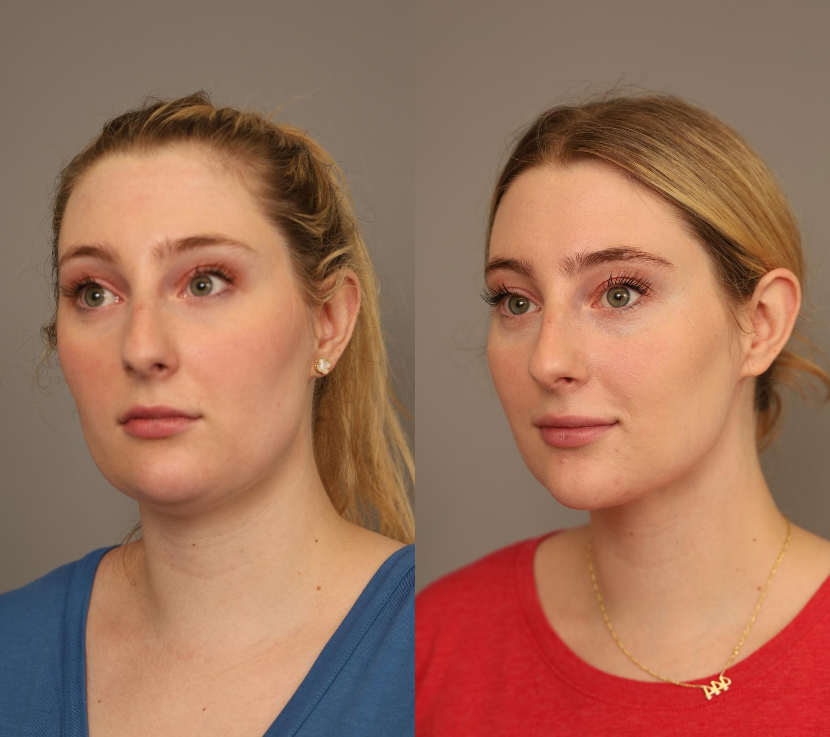Neck Liposuction Before and After